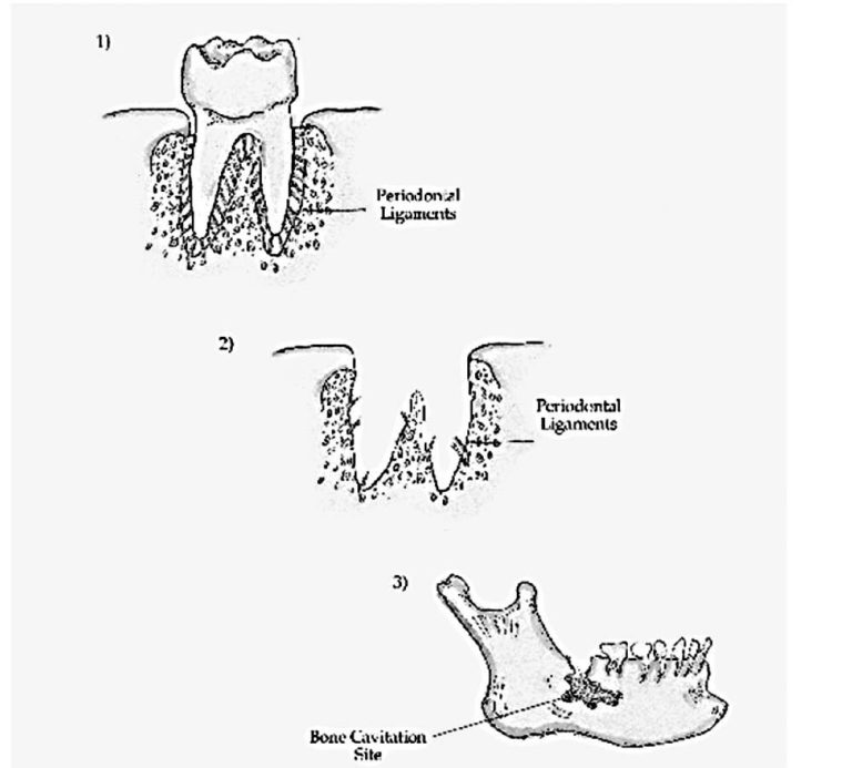 Dental Cavitation Surgery - The Weston A. Price Foundation