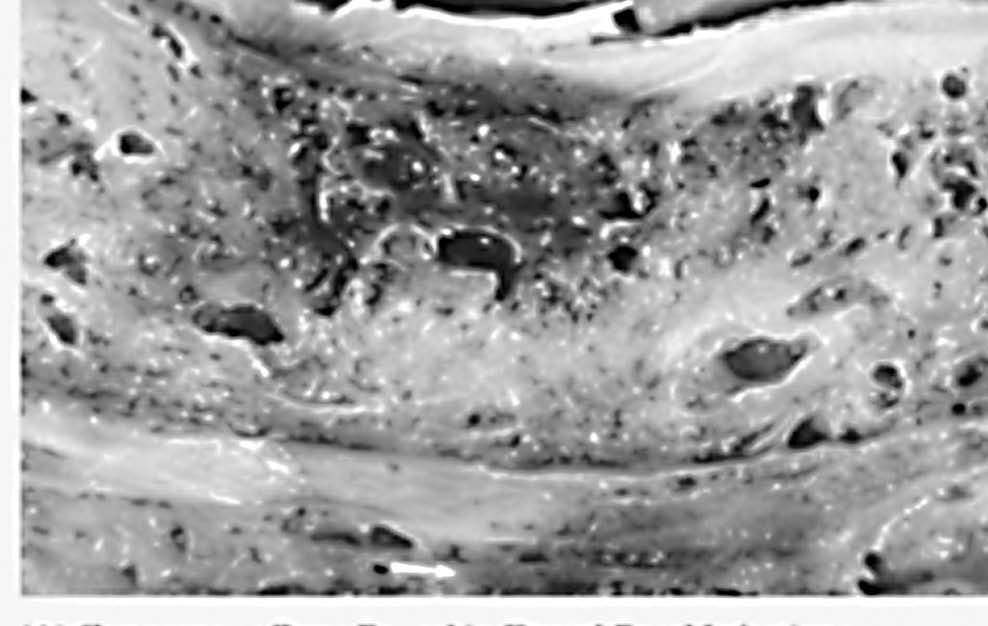 Dental Cavitation Surgery - The Weston A. Price Foundation